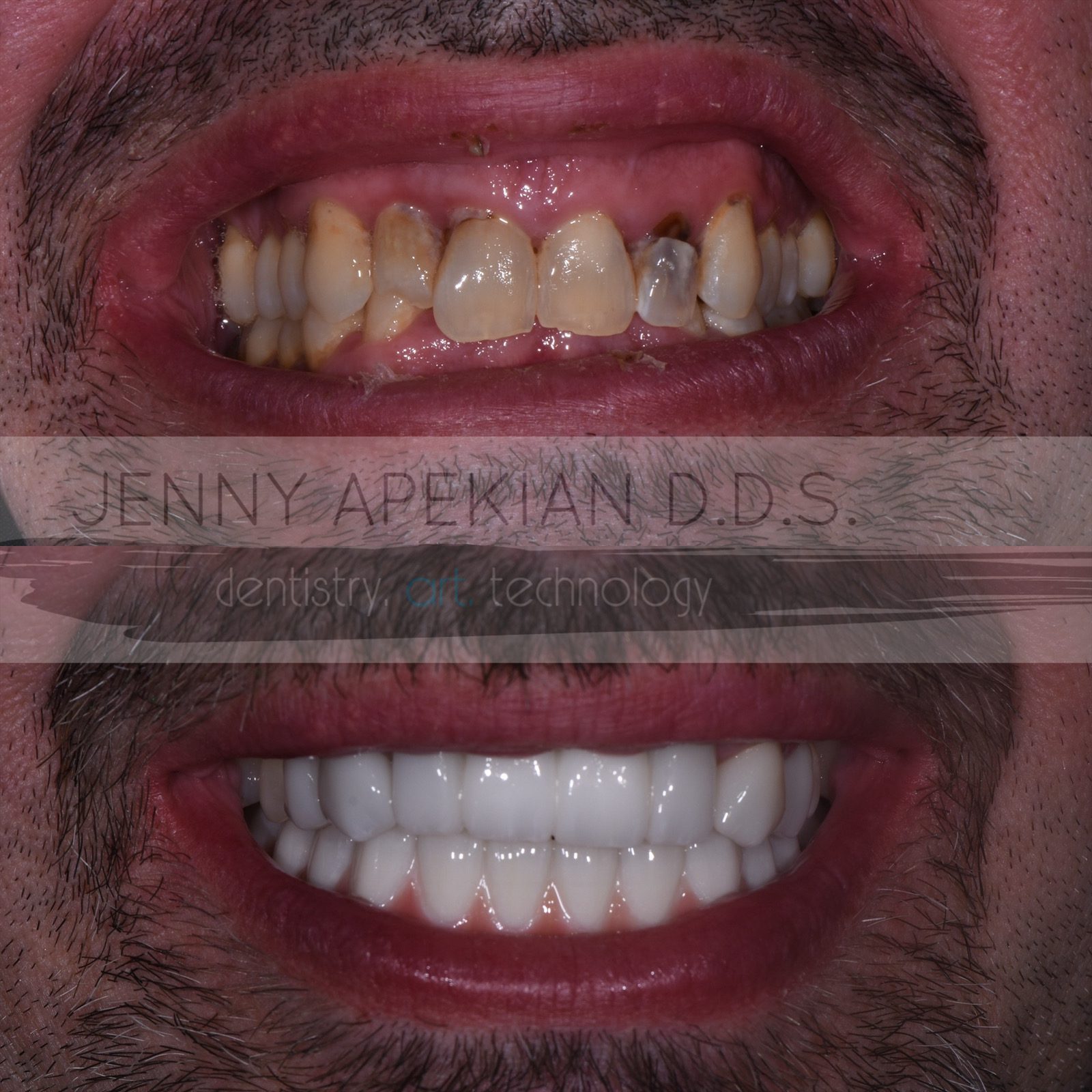 Implants with Bridges Before & After - Midtown Dental - Sacramento, CA