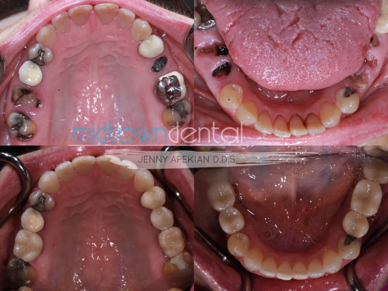 Multiple Missing Teeth Before and After - Midtown Dental - Sacramento, CA