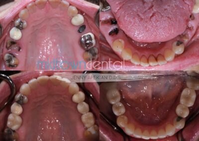 Multiple Missing Teeth Before and After - Midtown Dental - Sacramento, CA