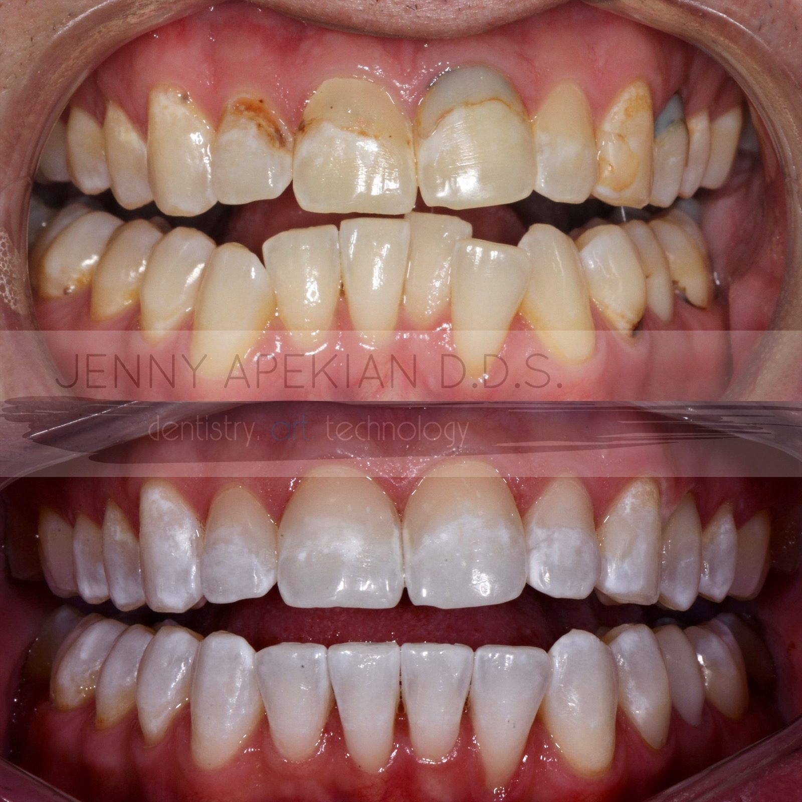 Invisalign Treatment Before & After - Midtown Dental - Sacramento, CA