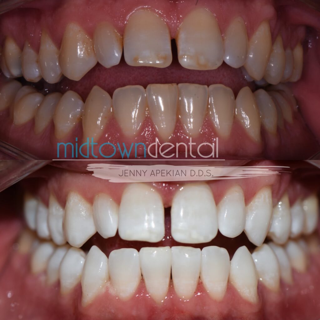 Teeth Whitening Before & After - Midtown Dental - Sacramento, CA